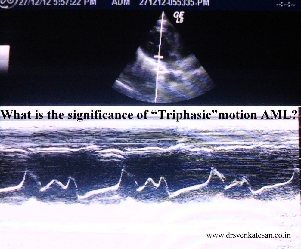 echocardiography | Dr.S.Venkatesan MD