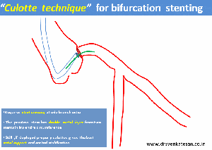 Cullotte technique in bifurcation coronary stenting | Dr.S.Venkatesan MD