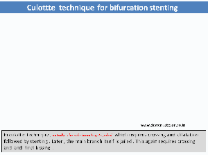 Cullotte technique in bifurcation coronary stenting | Dr.S.Venkatesan MD