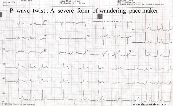 Wandering Atrial Pacemaker Atrial Dysrhythmias