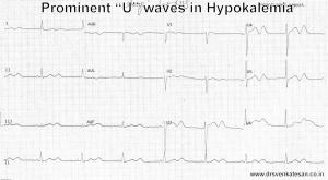 hypokalemia in ecg | Dr.S.Venkatesan MD