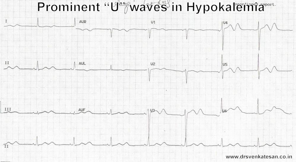 When sinus bradycardia accompanies hypokalemia “U” waves appear in a ...