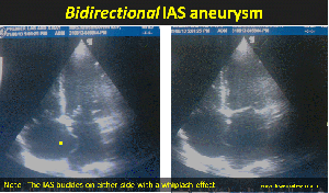 ias aneurysm | Dr.S.Venkatesan MD