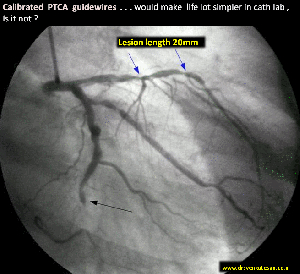 Calibrated PTCA guidewires : A simple Innovation can make cardiologist ...