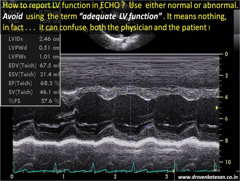 LV ejection fraction | Dr.S.Venkatesan MD