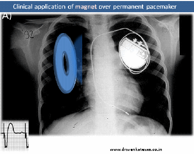 What is the role of magnet in pacemaker evaluation ? | Dr.S.Venkatesan MD