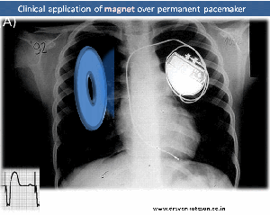 What is the role of magnet in pacemaker evaluation ? | Dr.S.Venkatesan MD