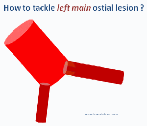 Left main stenting -Tips and tricks | Dr.S.Venkatesan MD