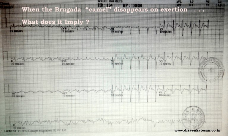 Brugada syndrome | Dr.S.Venkatesan MD