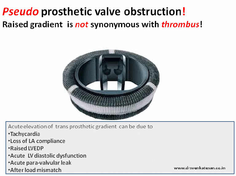 Guessing games with prosthetic valve gradients ! | Dr.S.Venkatesan MD