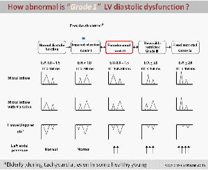 grading of diastolic dysfunction | Dr.S.Venkatesan MD