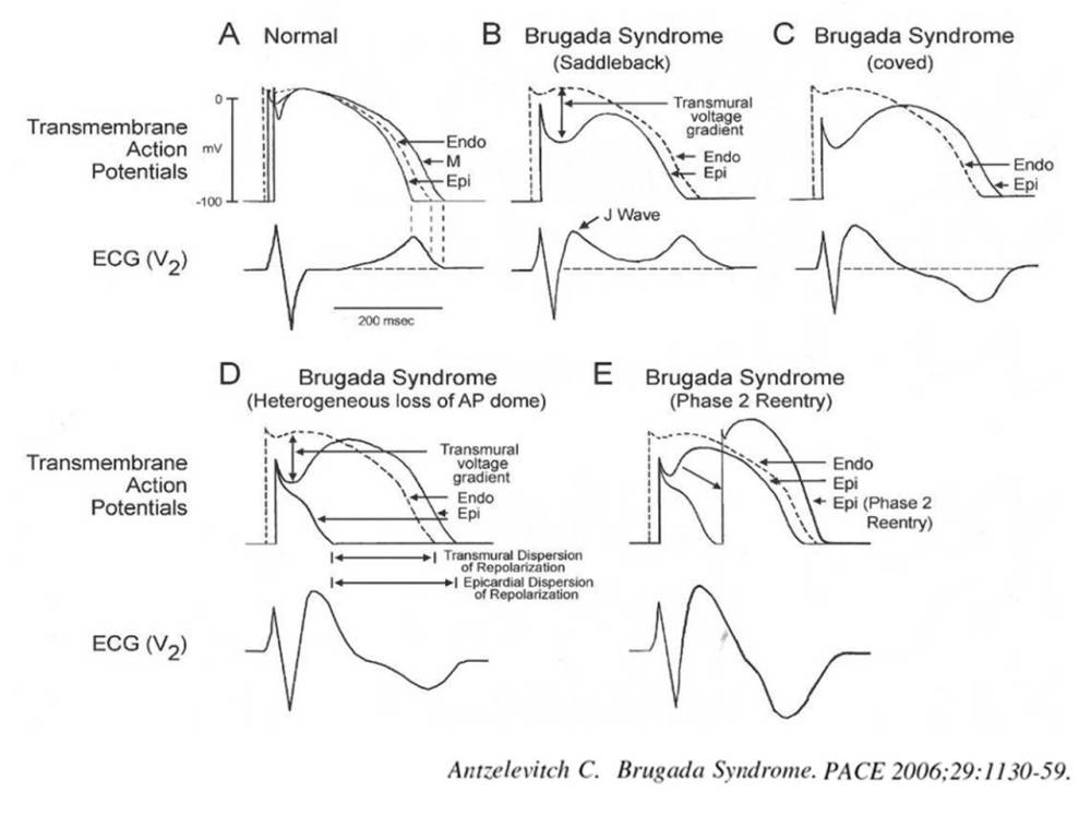 Brugada syndrome | Dr.S.Venkatesan MD