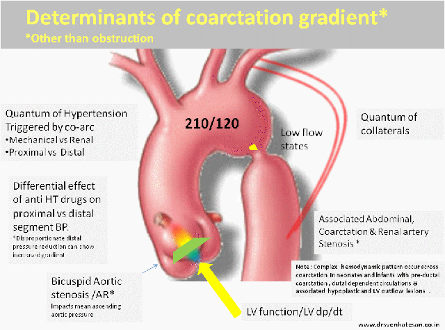 Differential Cyanosis In Coarctation Of Aorta