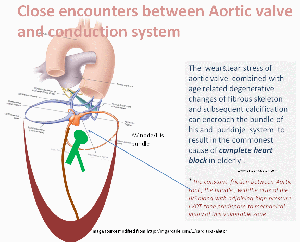 Anatomical encounters of Aortic valve with bundle of His : An ...