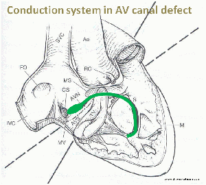 conduction system in common av canal defect | Dr.S.Venkatesan MD