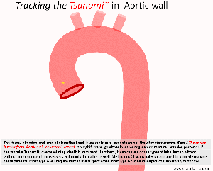 aortic dissection | Dr.S.Venkatesan MD