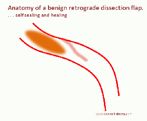 flow limiting vs non flow limiting dissection | Dr.S.Venkatesan MD