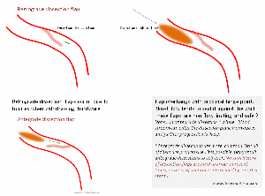Anatomical basis of self sealing coronary dissection flaps : An ...