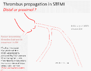 thrombus stemi | Dr.S.Venkatesan MD