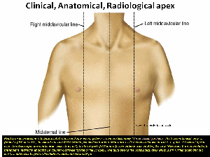 Three types of cardiac apical Impulse : An Illustration | Dr.S ...