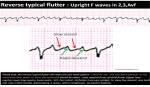 This simple question in Atrial Flutter ECG bothered me for long ...