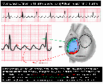 This simple question in Atrial Flutter ECG bothered me for long ...