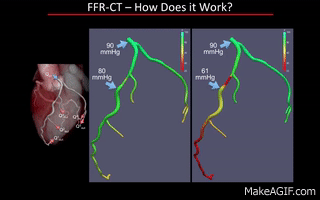 Functional CT coronary Angiogram :Live coronary traffic Info on the go ...