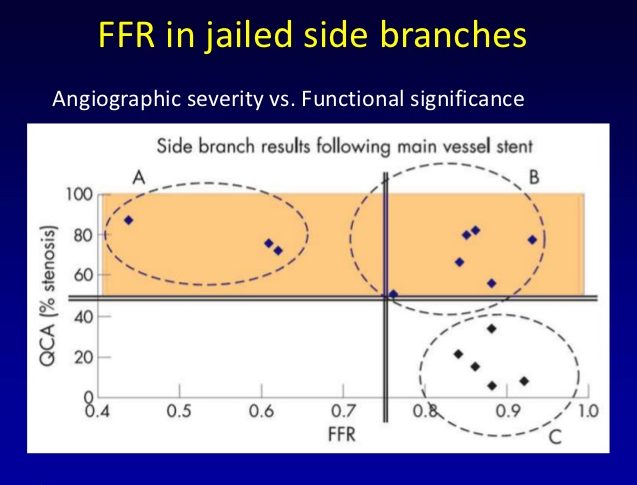 ffr in side branch jailing | Dr.S.Venkatesan MD