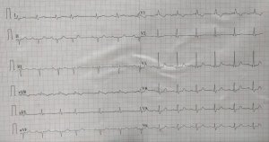 RBBB vs RVH | Dr.S.Venkatesan MD
