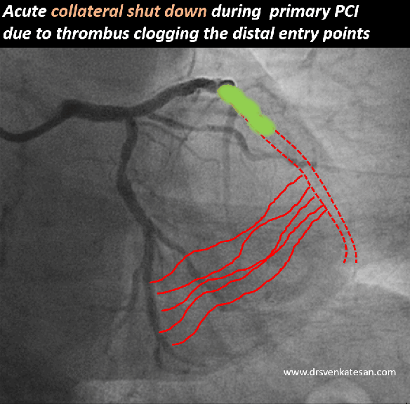 No Reflow And Slow Flow Phenomenon During Pci The Evaluation Of The