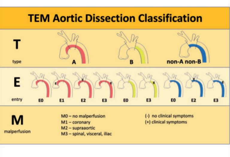 Non- A, Non -B Aortic dissection : Incidence ,classification & outcome ...