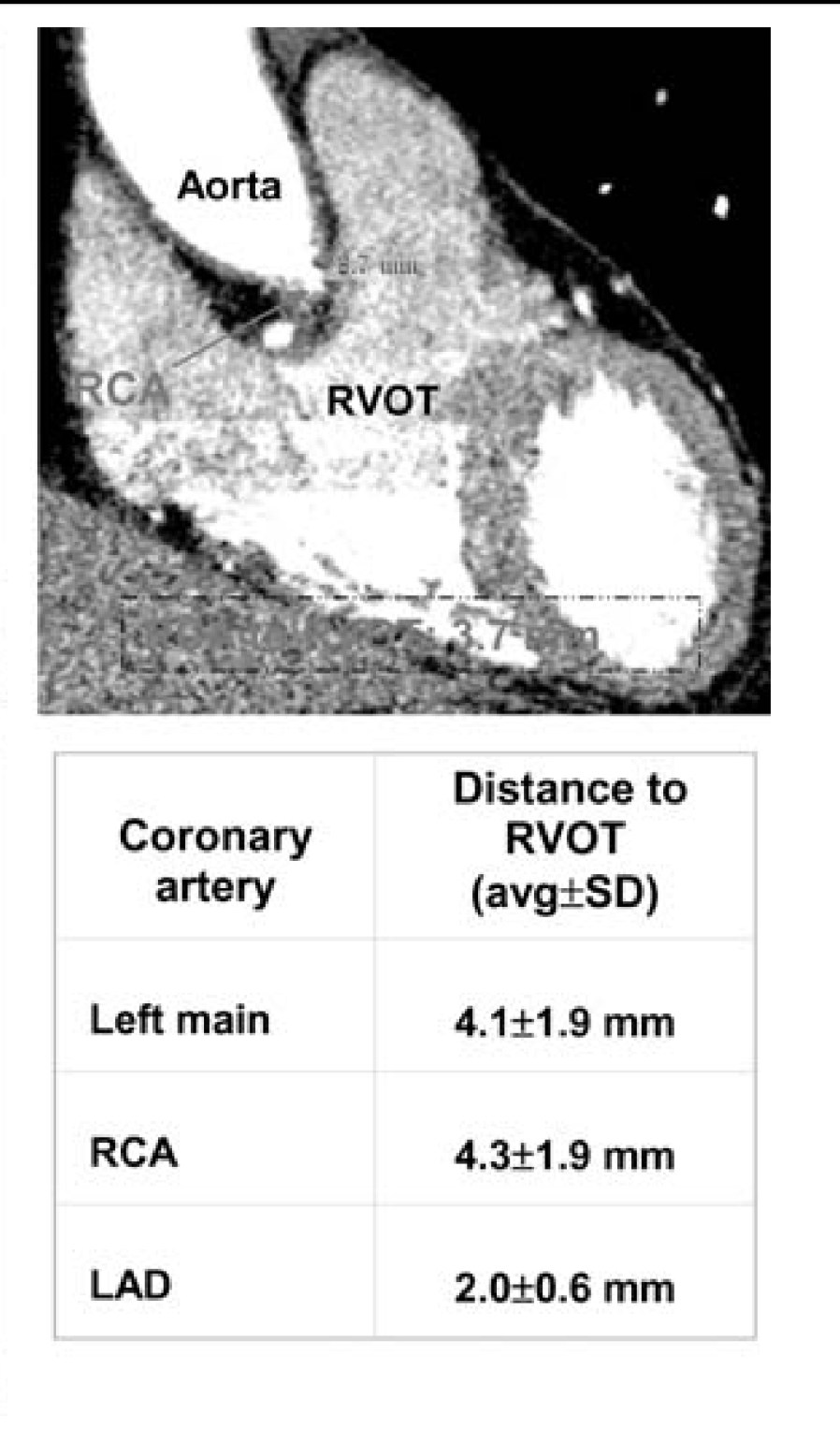 Anatomical paradox: When ventricular outflows crisscross , left main ...