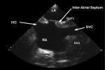TEE Bicaval view : An anatomical orientation | Dr.S.Venkatesan MD
