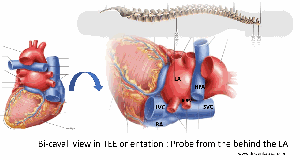 TEE Bicaval view : An anatomical orientation | Dr.S.Venkatesan MD