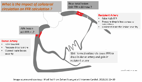 Effect of coronary collaterals on FFR measurement | Dr.S.Venkatesan MD