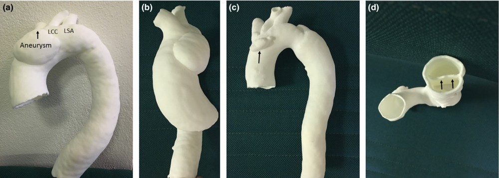 normal aorta size | Dr.S.Venkatesan MD