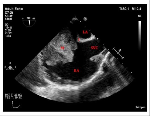 TEE Bicaval view : An anatomical orientation | Dr.S.Venkatesan MD