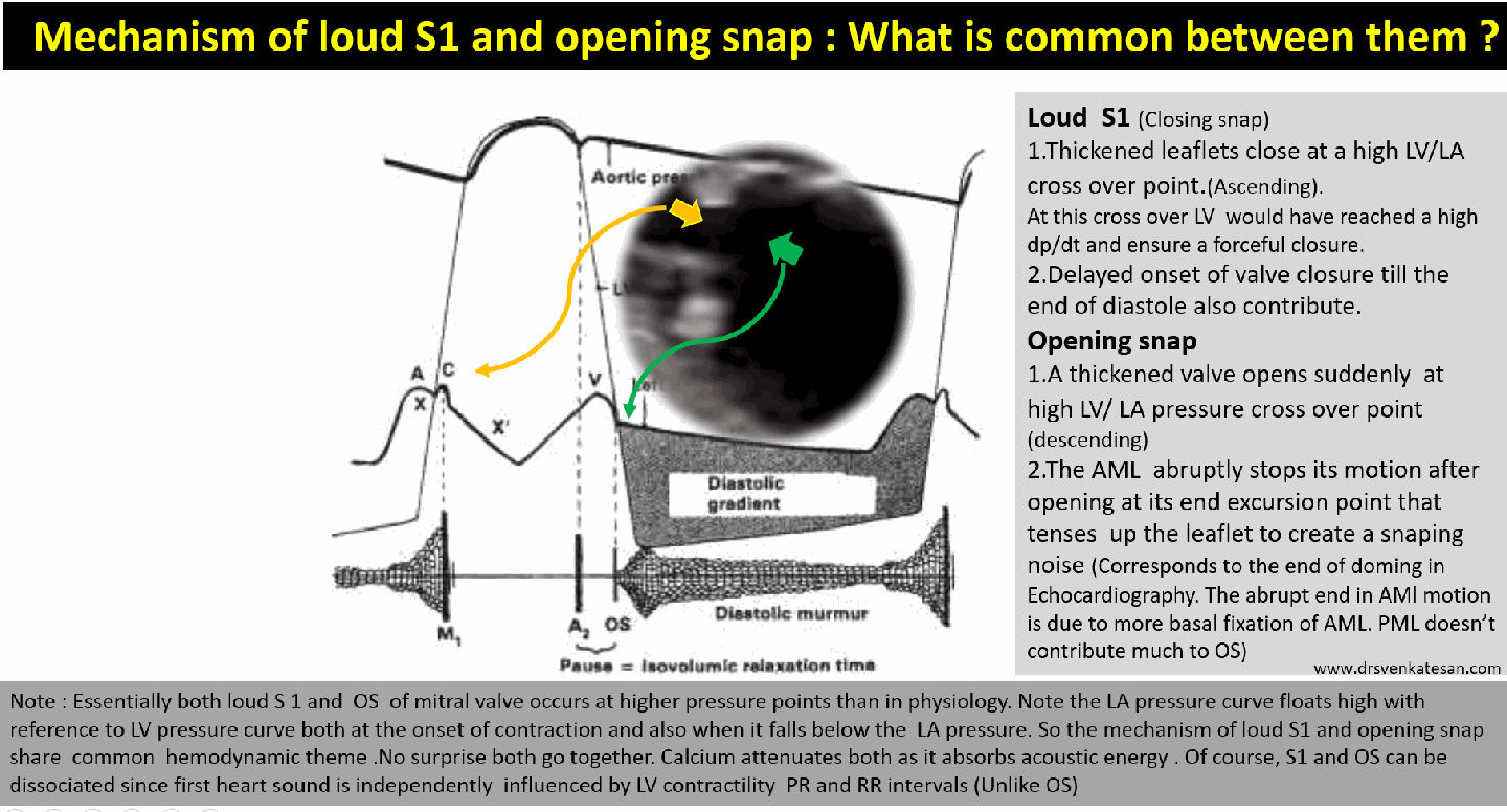 “Loud S1” and “Opening snap” in mitral stenosis : Do they always go ...