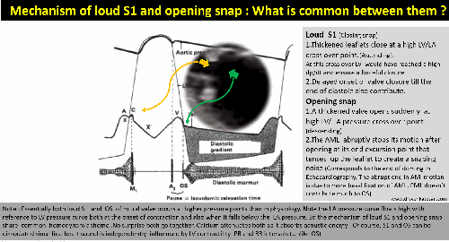 “Loud S1” and “Opening snap” in mitral stenosis : Do they always go ...
