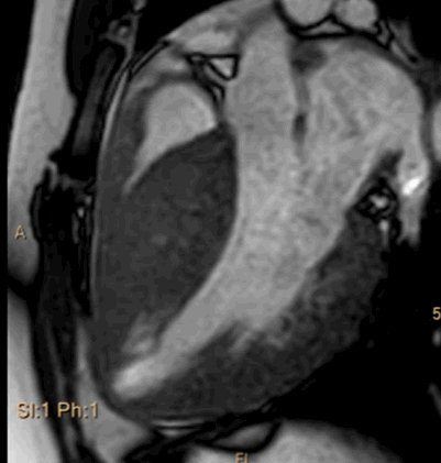 what is the mechanism of hocm gradient lvot | Dr.S.Venkatesan MD