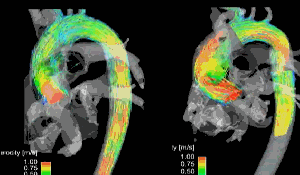 Aortic diseases | Dr.S.Venkatesan MD