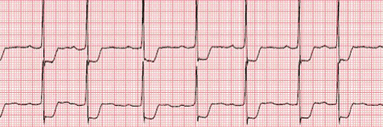 Learning new lessons from a stressful “ST segment” | Dr.S.Venkatesan MD