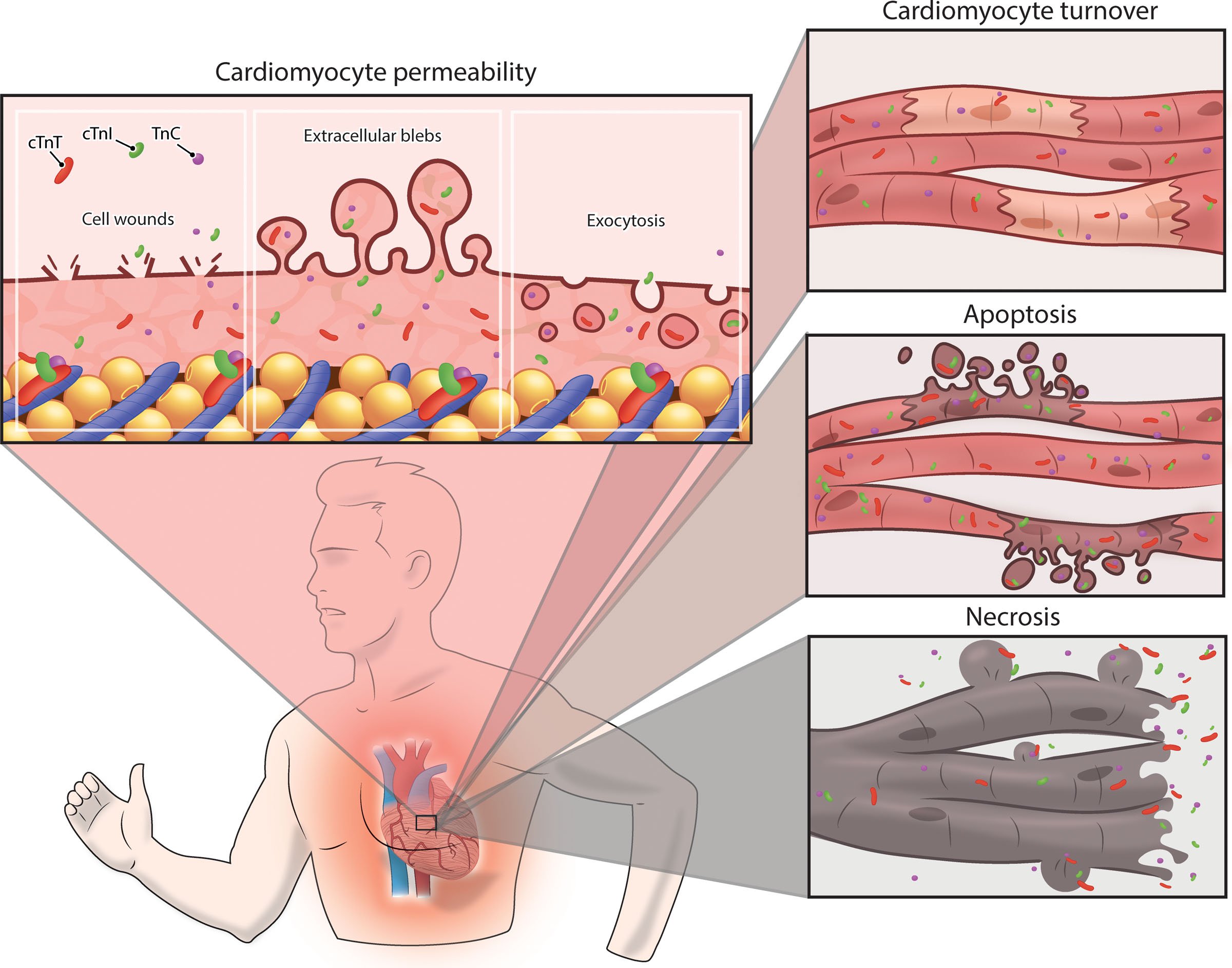 Mechanism of Troponin release in “Marathon runners” ? | Dr.S.Venkatesan MD