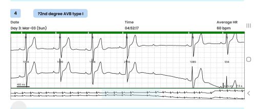 2:1 av block | Dr.S.Venkatesan MD