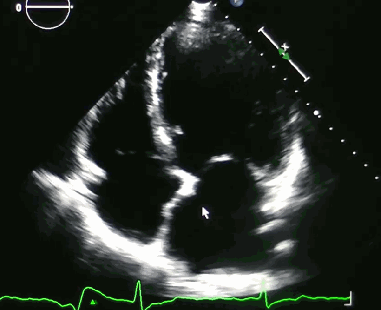left atrial vs right atrial fibrillation | Dr.S.Venkatesan MD
