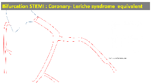 Coronary Leriche syndrome: An often missed sub-set of left main STEMI ...
