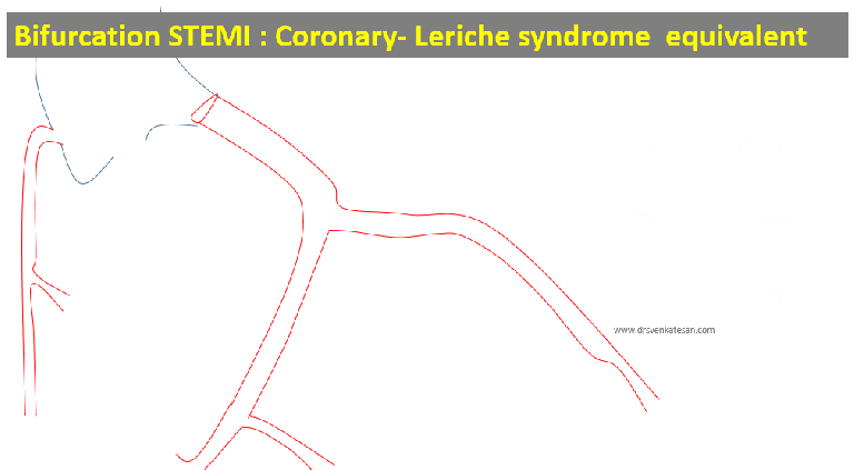 Coronary Leriche syndrome: An often missed sub-set of left main STEMI ...
