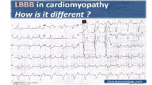What is the mechanism of LBBB in DCM ? How does left bundle branch ...