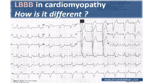 What is the mechanism of LBBB in DCM ? How does left bundle branch ...
