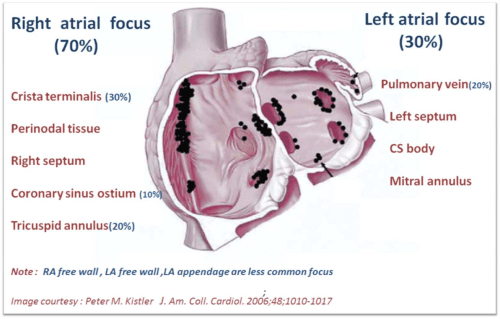 Right atrial origin of Atrial fibrillation : Why we Ignore IVC ,SVC ...